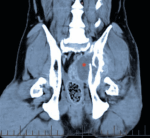 THE ROLE OF HEMIPELVECTOMY IN DEFINITIVE AND PALLIATIVE TREATMENT OF ...