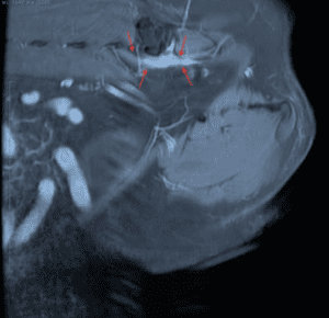 THE ROLE OF HEMIPELVECTOMY IN DEFINITIVE AND PALLIATIVE TREATMENT OF ...